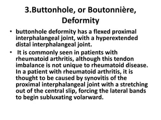 Deformities of hand in rheumatoid arthritis | PPTX