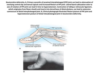 Deformities of hand in rheumatoid arthritis | PPTX
