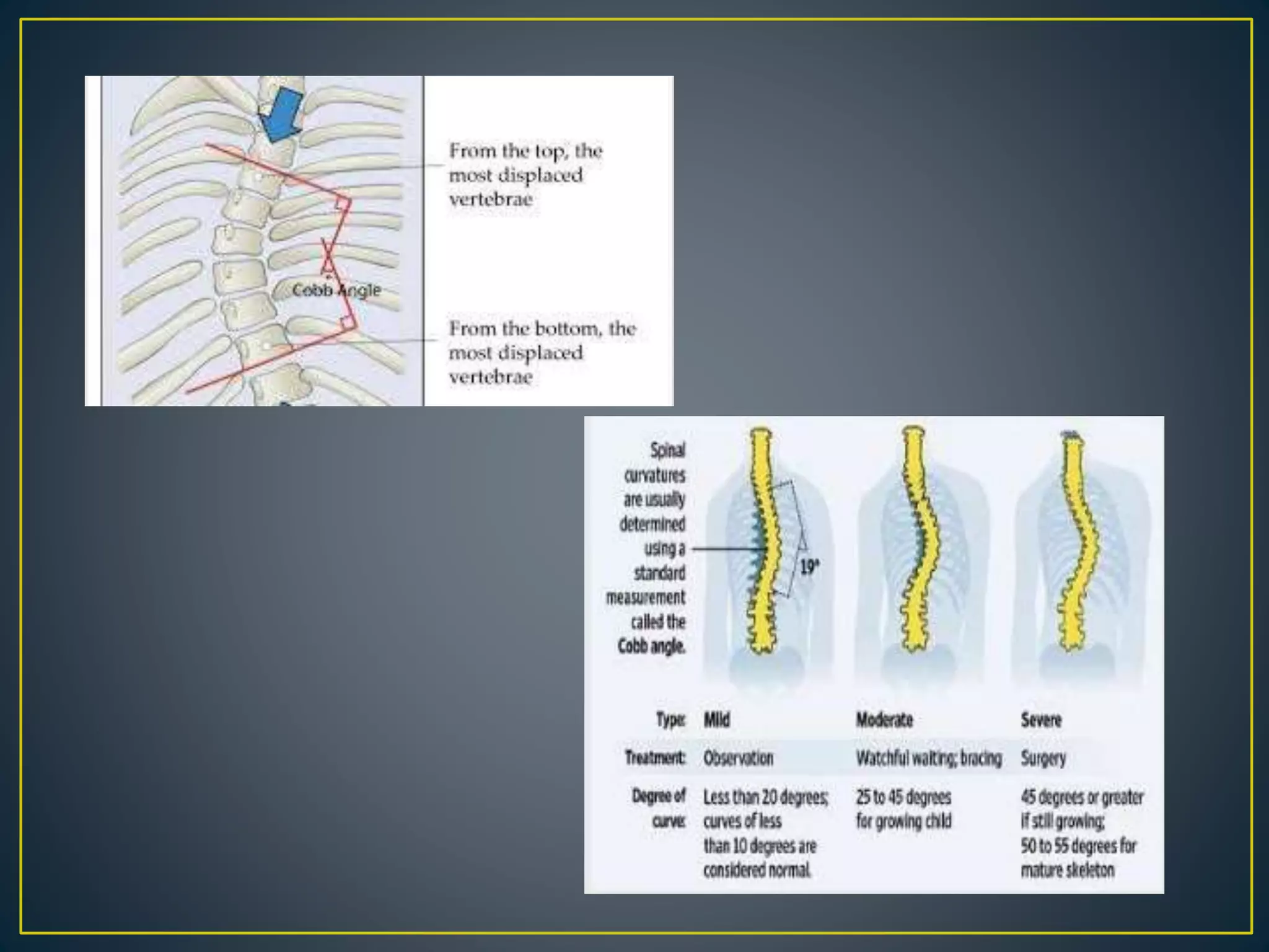 Deformities of spine | PPTX