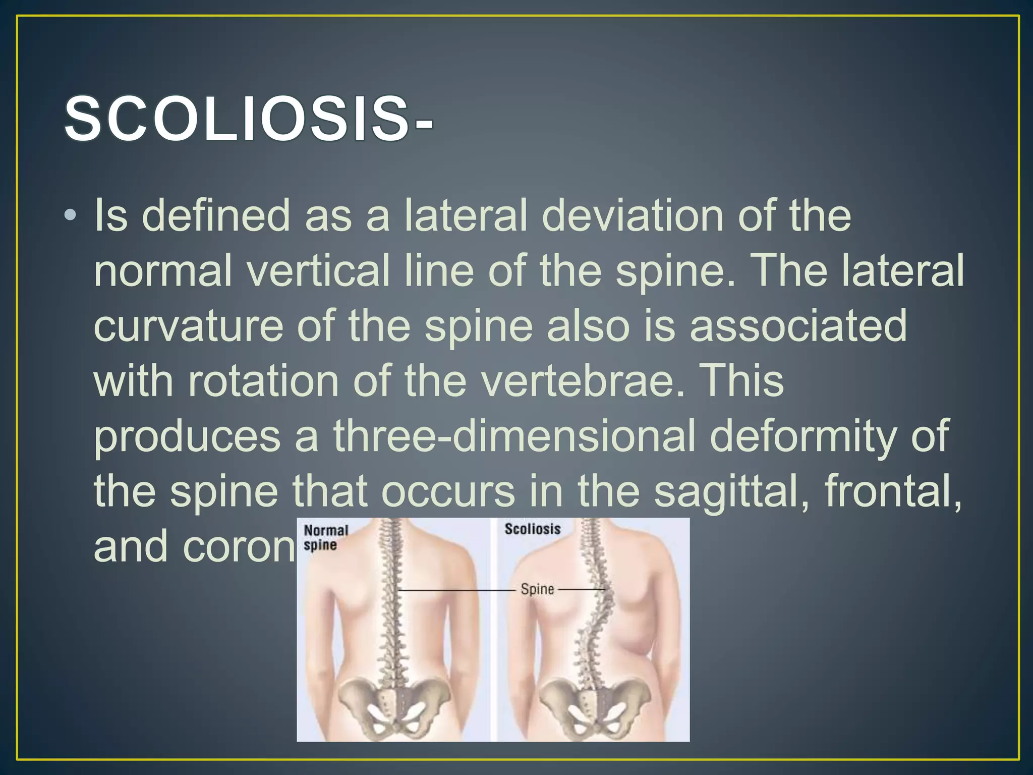 Deformities of spine | PPTX
