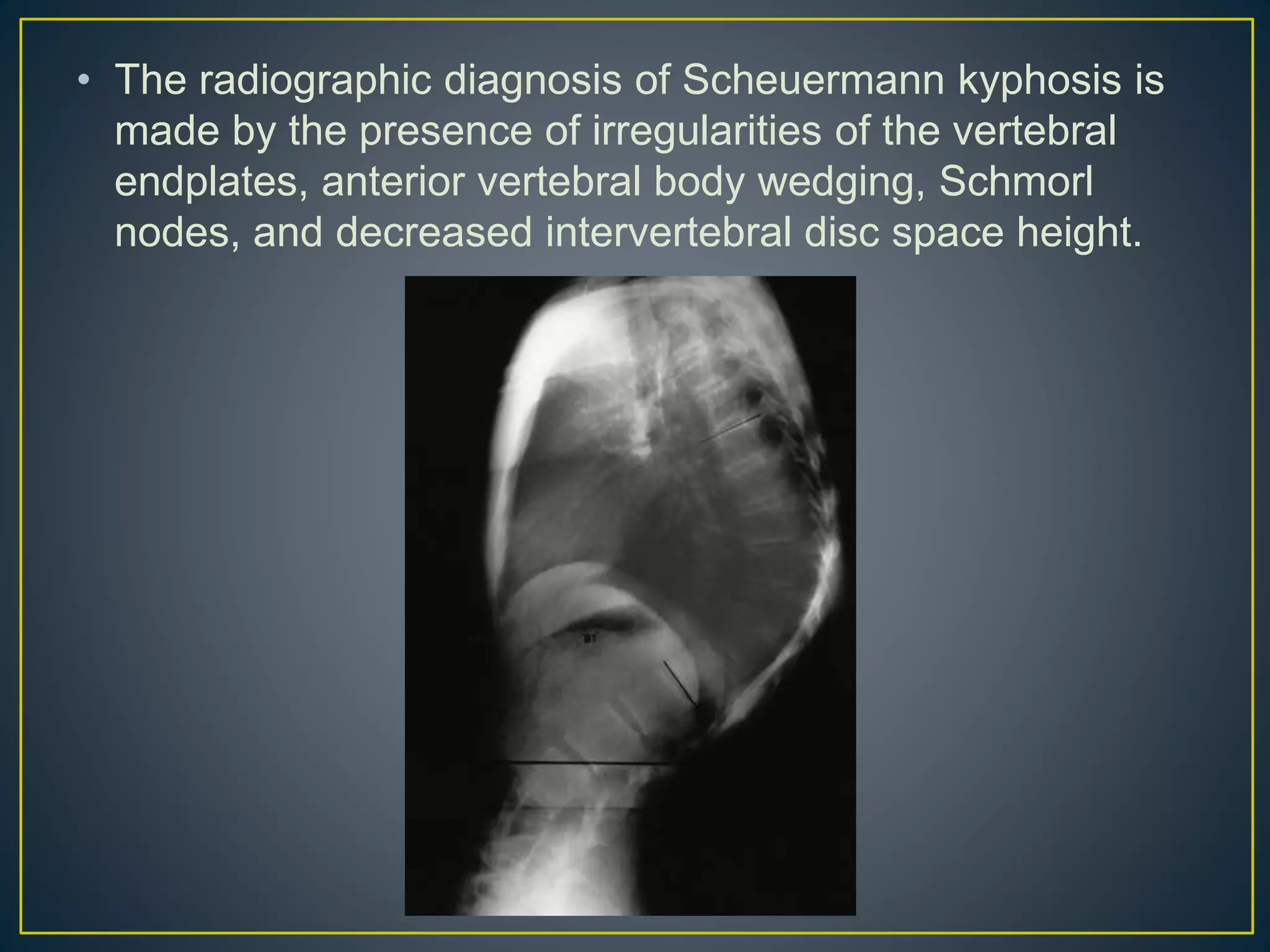 Deformities of spine | PPTX