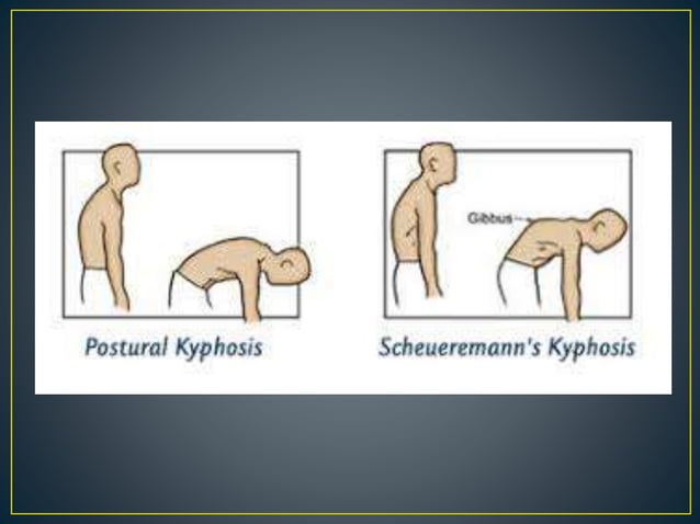 Deformities of spine | PPTX | Physical Therapy | Wellness