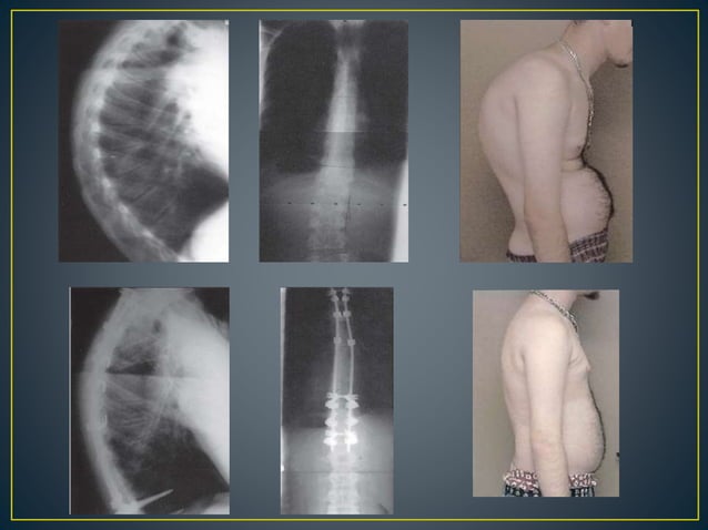 Deformities of spine | PPTX | Physical Therapy | Wellness