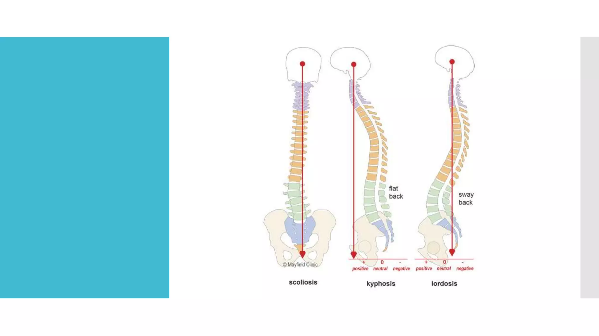 DEFORMITIES OF SPINE.pptx
