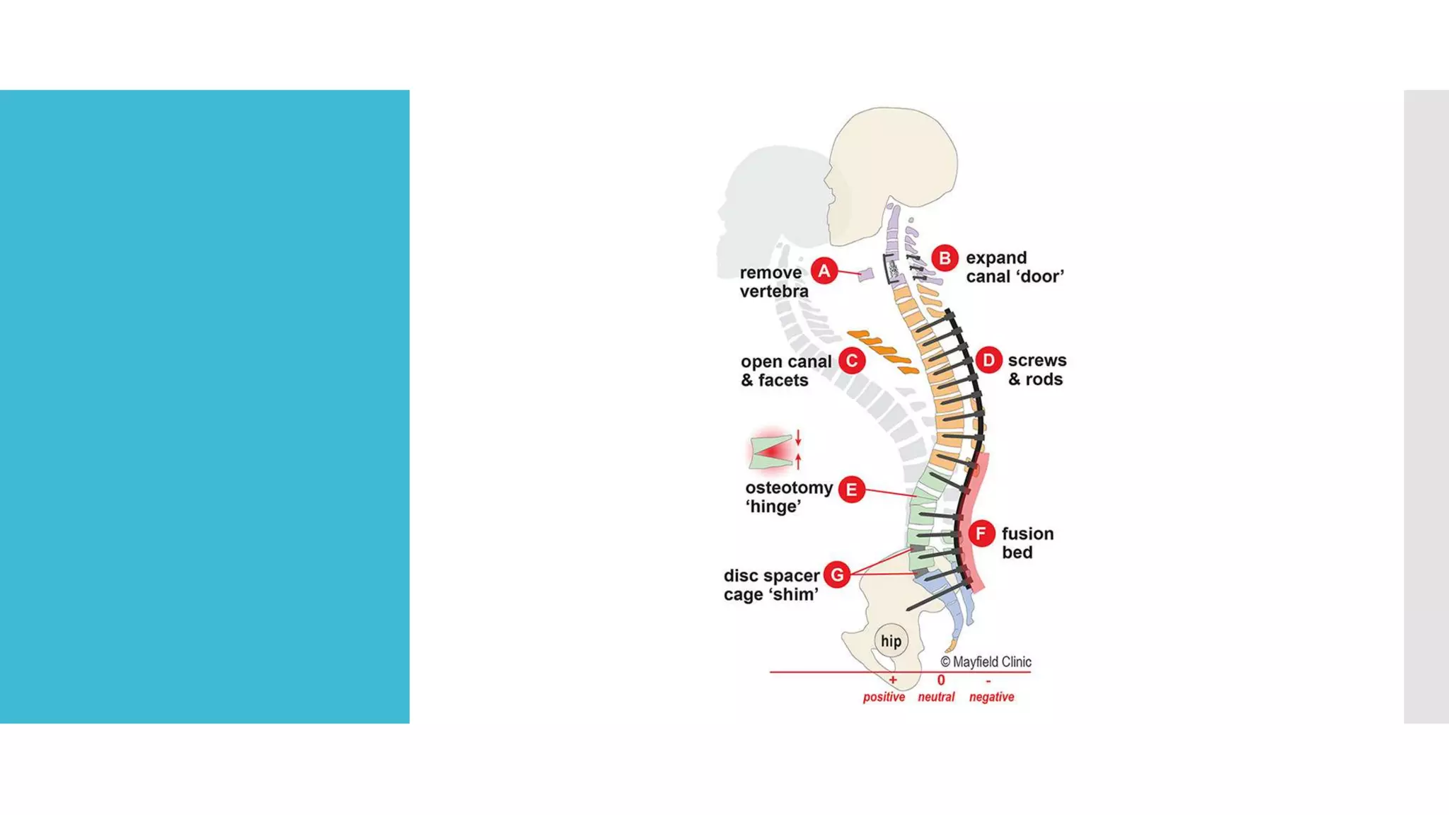 DEFORMITIES OF SPINE.pptx