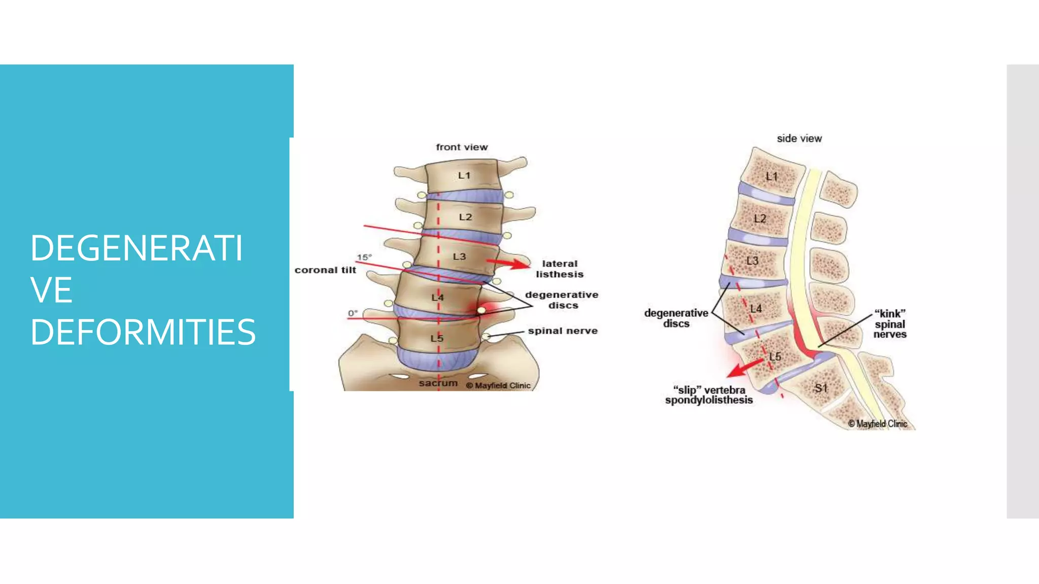 DEFORMITIES OF SPINE.pptx