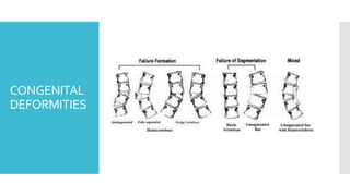 DEFORMITIES OF SPINE.pptx