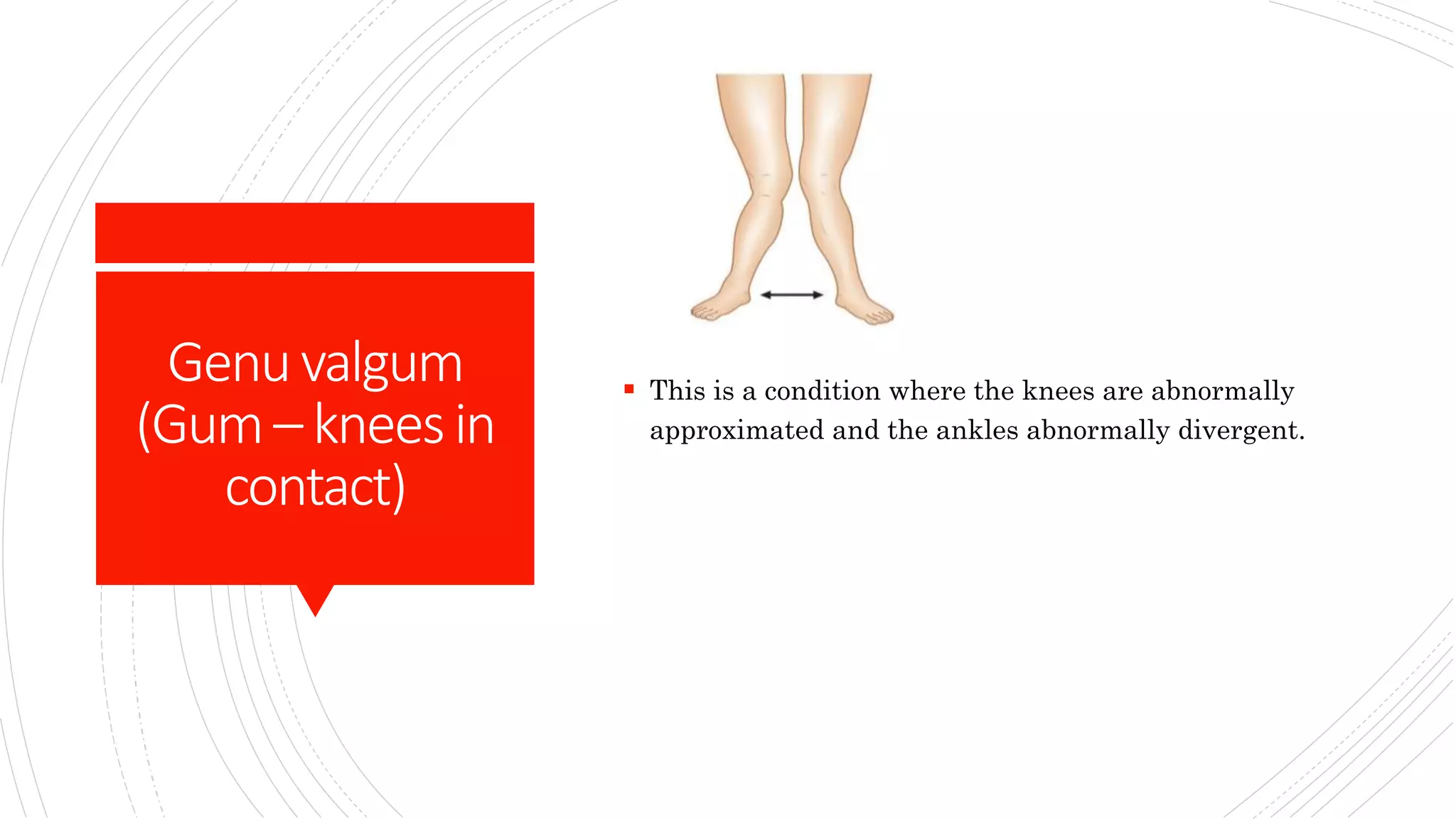 Deformities of the knee | PPTX