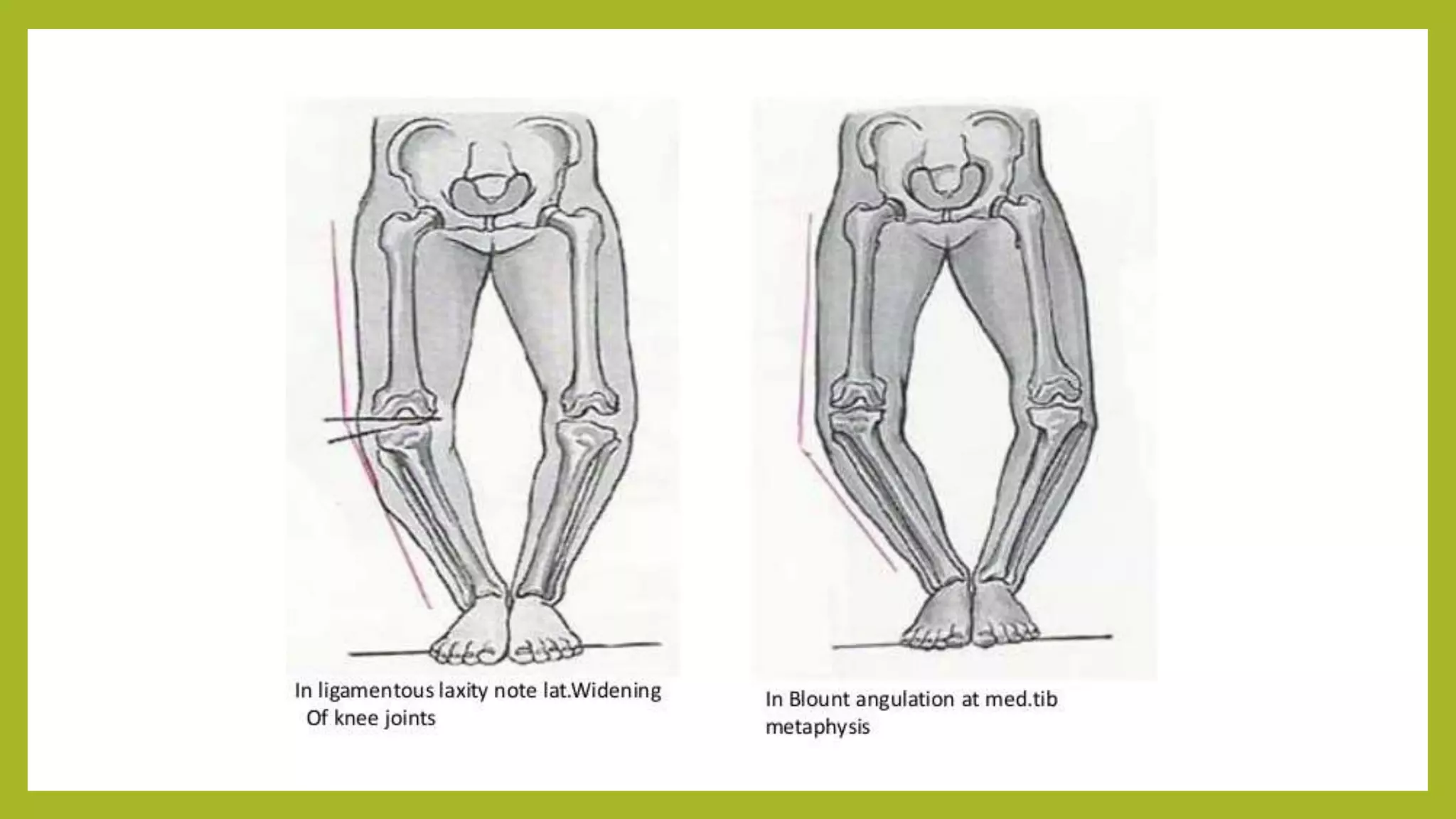 Deformity around knee joint | PPTX