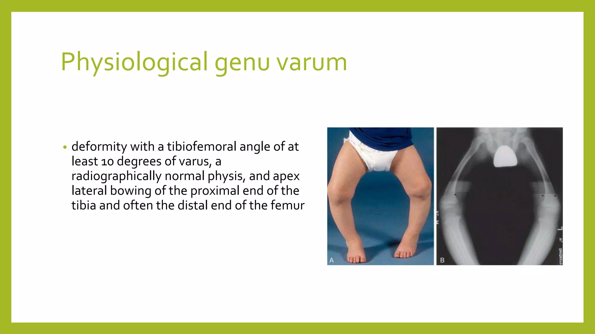 Deformity around knee joint | PPTX
