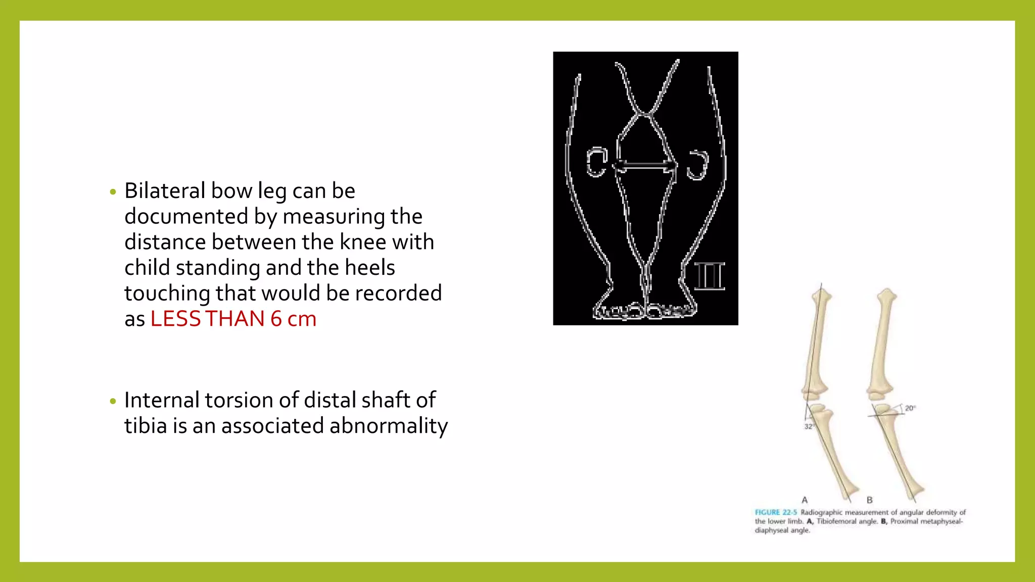 Deformity around knee joint | PPTX