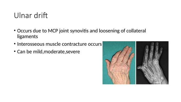 DEFORMITY IN RA upperlimb anmd lowerlimb | PPTX