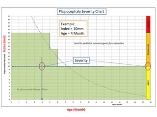 Plagiocephaly Measurement with Craniometer: Diagnosis, Prevention ...