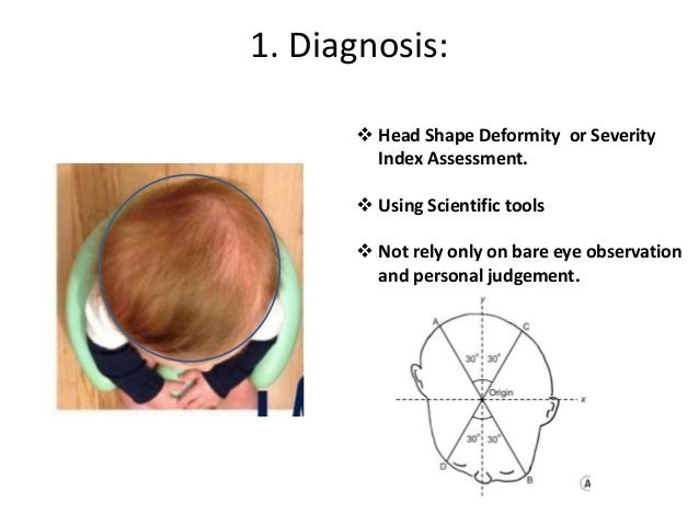Plagiocephaly Measurement with Craniometer: Diagnosis, Prevention,