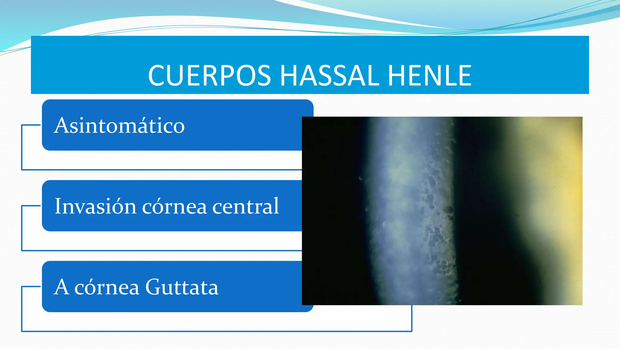 Degeneración Corneales más frecuentes.pptx