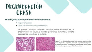 Degeneración e Infiltración.pdf diapositivas | PDF
