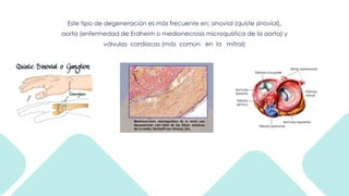 Degeneración e Infiltración.pdf diapositivas | PDF