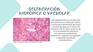 Degeneración e Infiltración.pdf diapositivas | PDF