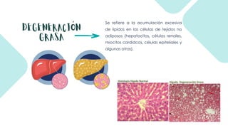 Degeneración e Infiltración.pdf diapositivas | PDF
