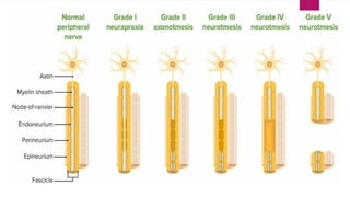 Degeneration and Regeneration of Nerve Fibers.pptx