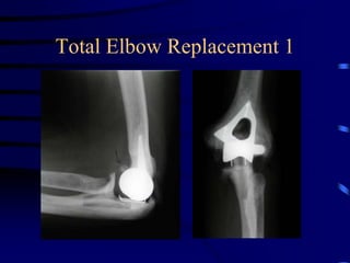 Degenerative arthritis-of-the-elbow | PPSX