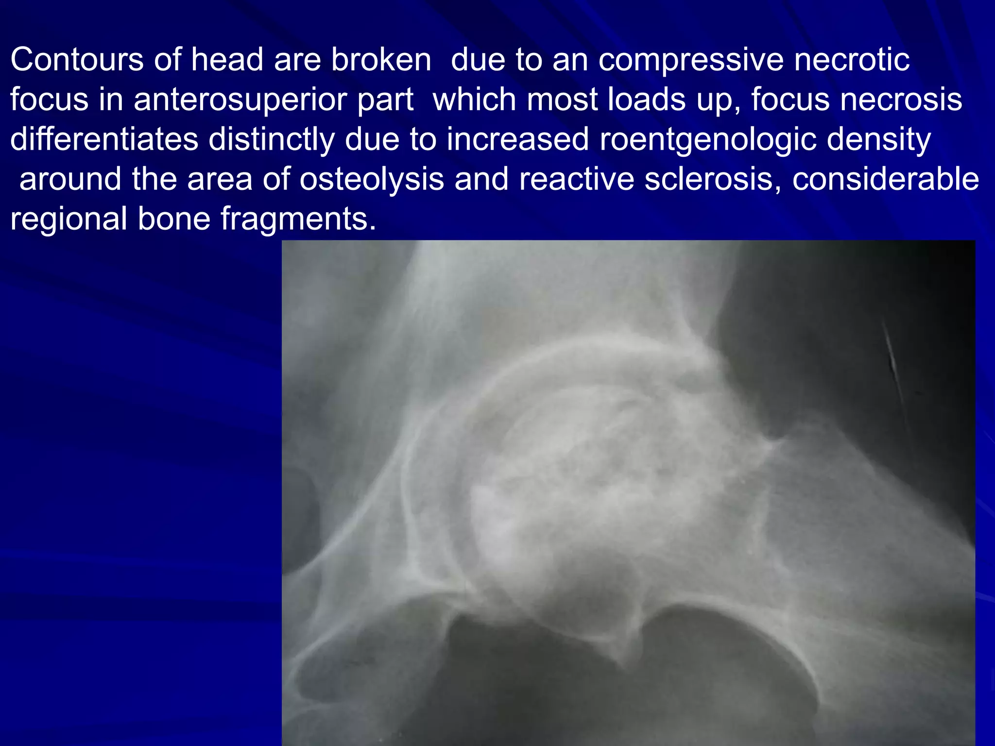 Degenerative dystrophic diseases of joints | PPT