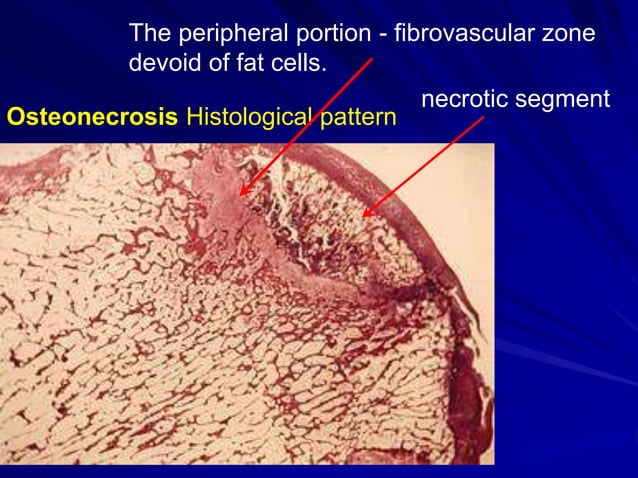 Degenerative dystrophic diseases of joints | PPT