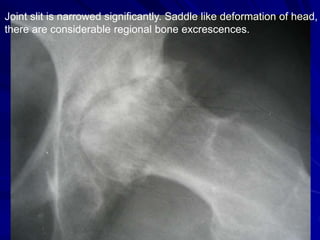 Degenerative dystrophic diseases of joints | PPT