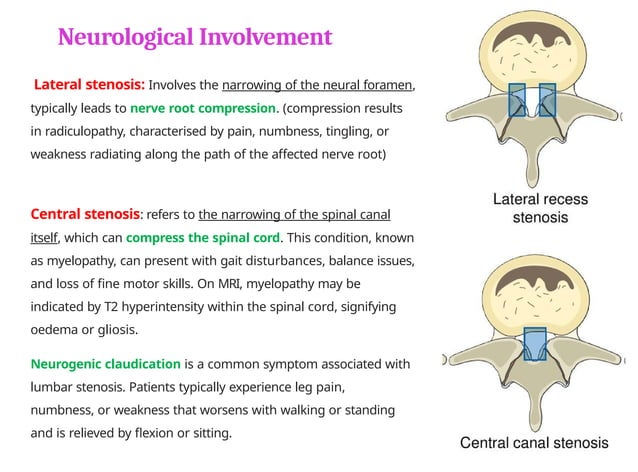 Degenerative-Joint-Disease-DJD-Cervical-Spondylosis-A-Comprehensive ...