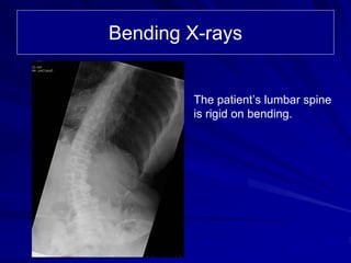 Case Review #18: 79 year old female with Degenerative scoliosis | PPT