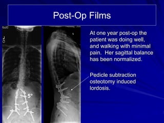 Case Review #18: 79 year old female with Degenerative scoliosis | PDF
