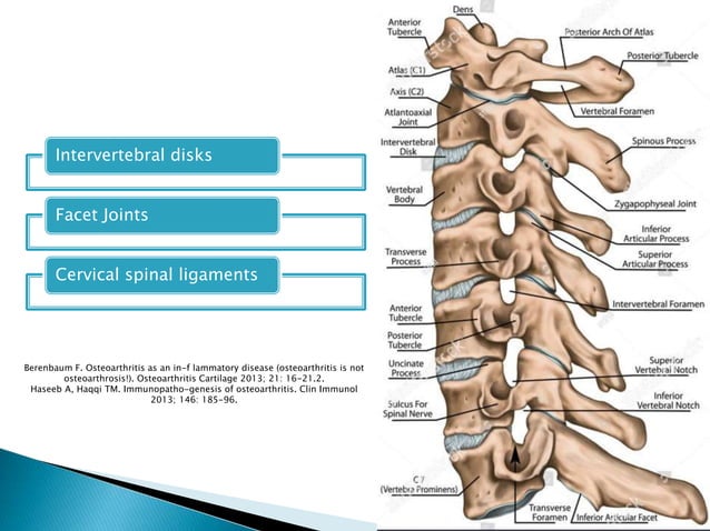 Degenerative Cervical Spondylosis | PPT