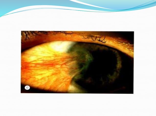 Degenerative condition of eye | PPTX | Eye and Vision Conditions ...