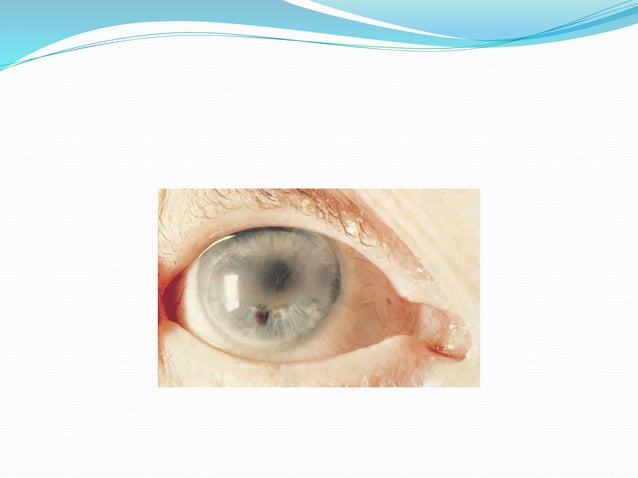 Degenerative condition of eye | PPTX | Eye and Vision Conditions ...