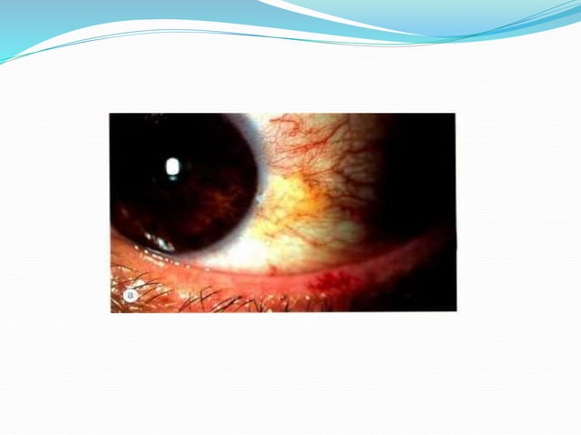 Degenerative condition of eye | PPTX | Eye and Vision Conditions ...