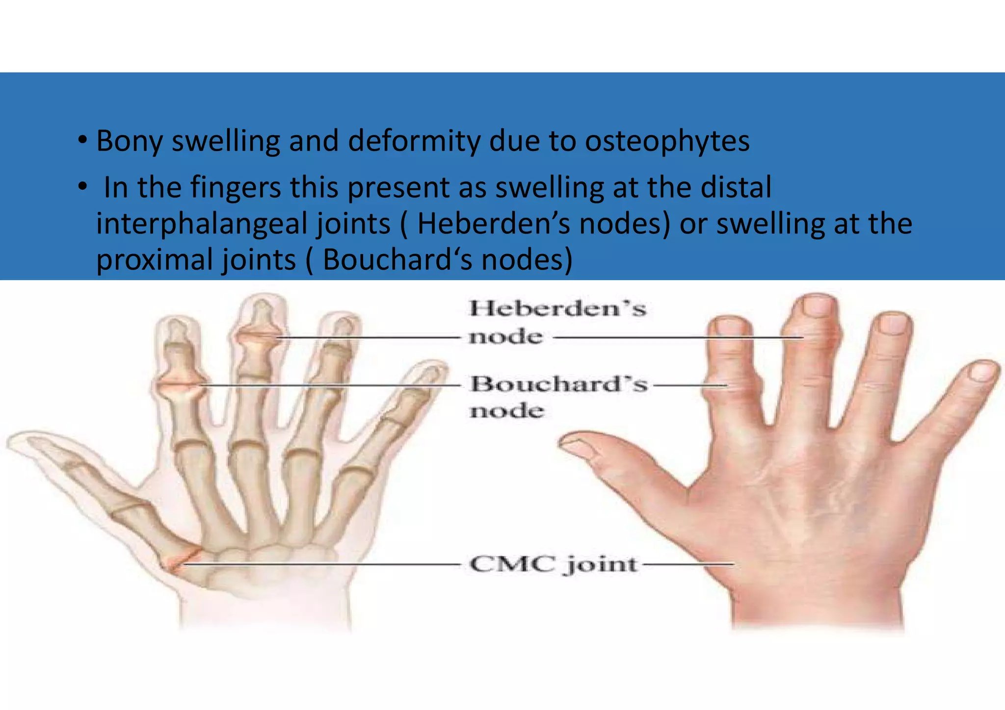 Degenerative condition of joints and spine For G.N.M 2nd & B.Sc.2nd ...