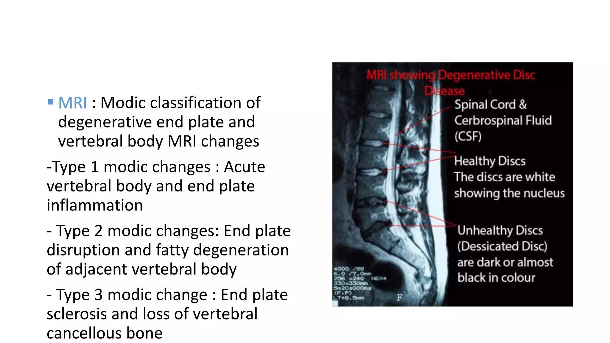 DEGENERATIVE DISC DISEASE 1.pptx