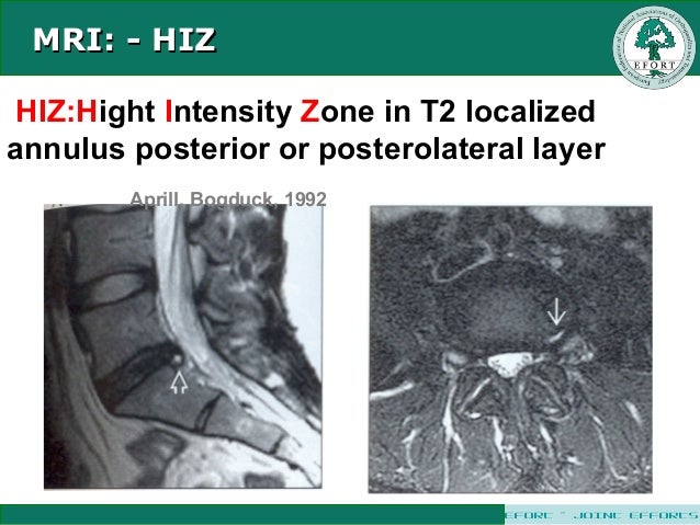 Degenerative Spine Conditions
