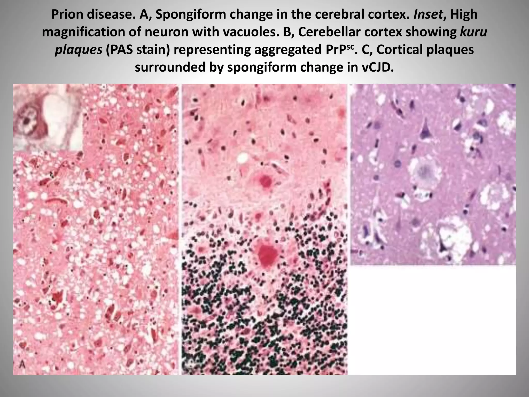 Degenerative diseases of cns | PPTX