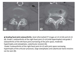 Degenerative diseases of spine : Imaging | PPT