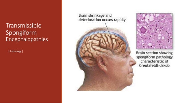 Neurological Disorders