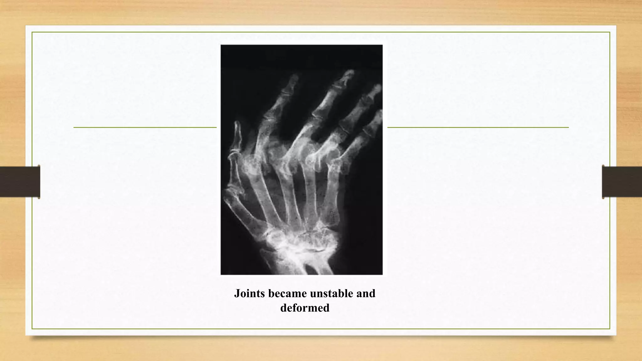 DEGENERATIVE JOINT DISEASE.pptx