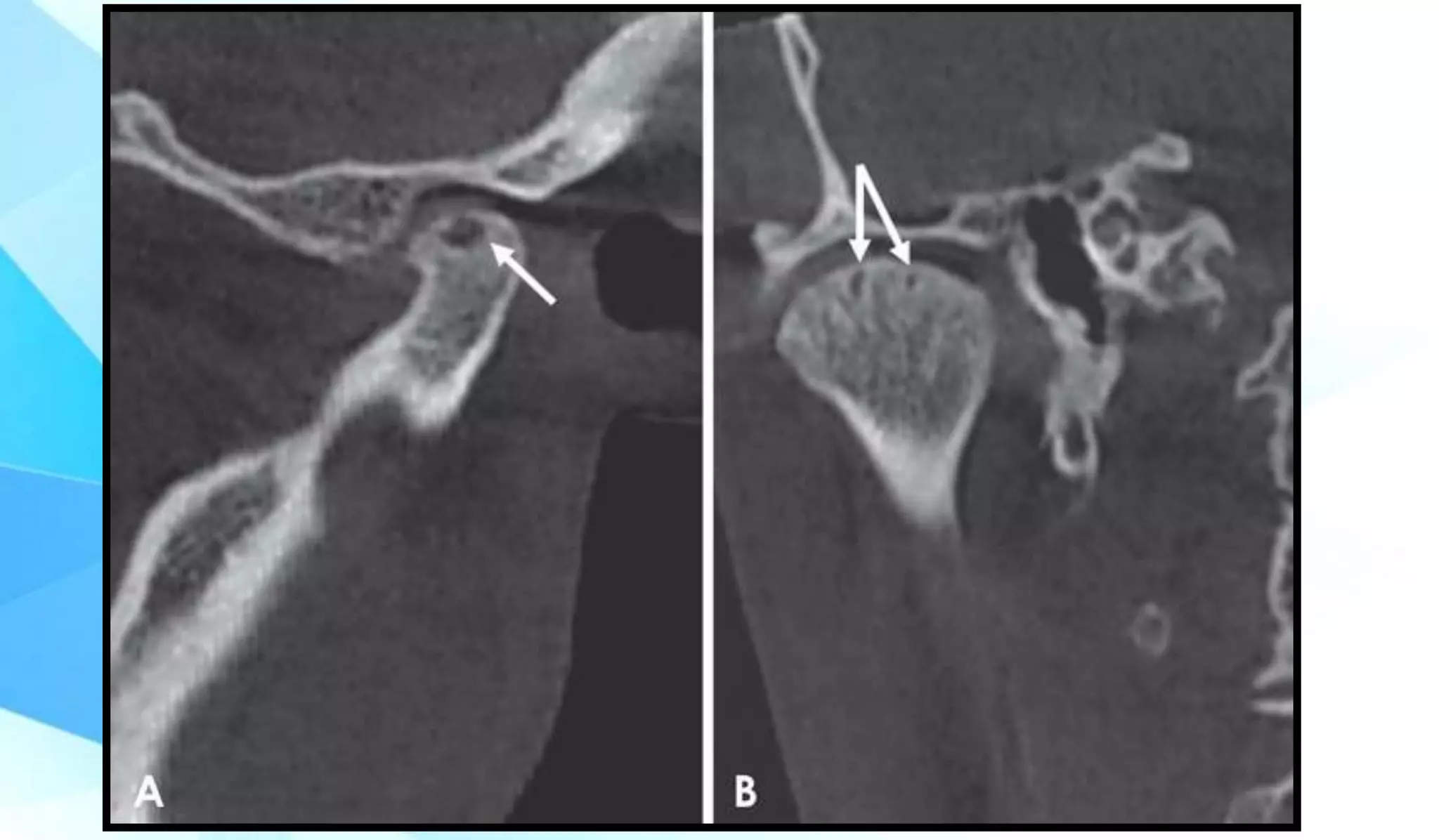 Degenerative joint disorders of temporomandibular joint | PPTX