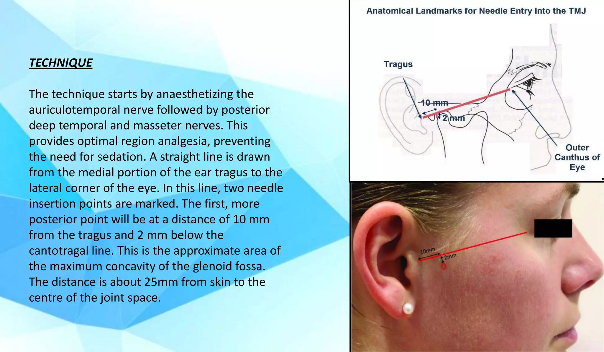 Degenerative joint disorders of temporomandibular joint | PPTX
