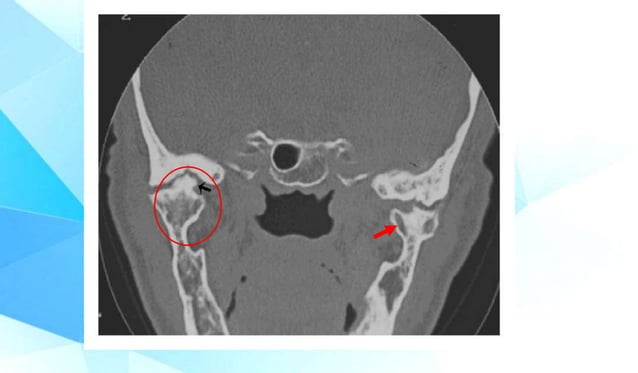 Degenerative joint disorders of temporomandibular joint | PPTX | Bone ...