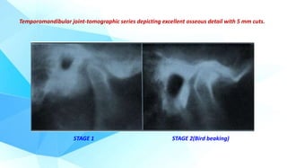Degenerative joint disorders of temporomandibular joint | PPTX