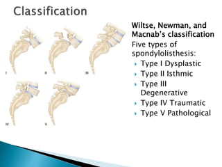 Degenerative Spondylolisthesis | PPT