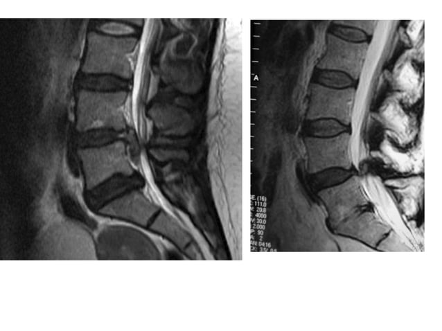 MRI IMAGING IN DEGENERATIVE SPINE DISEASES | PPTX
