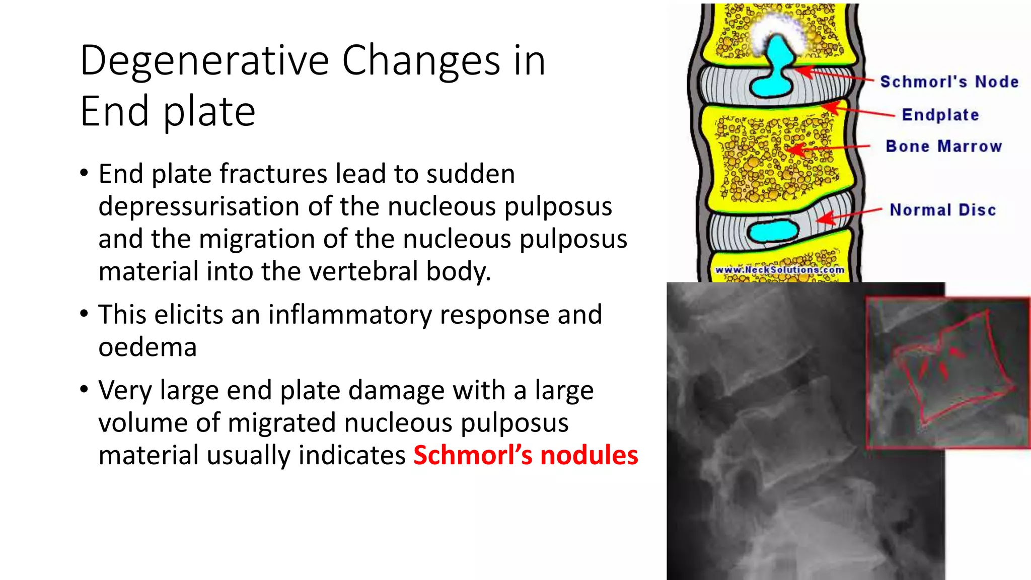 Degenerative Spine Disease.pptx