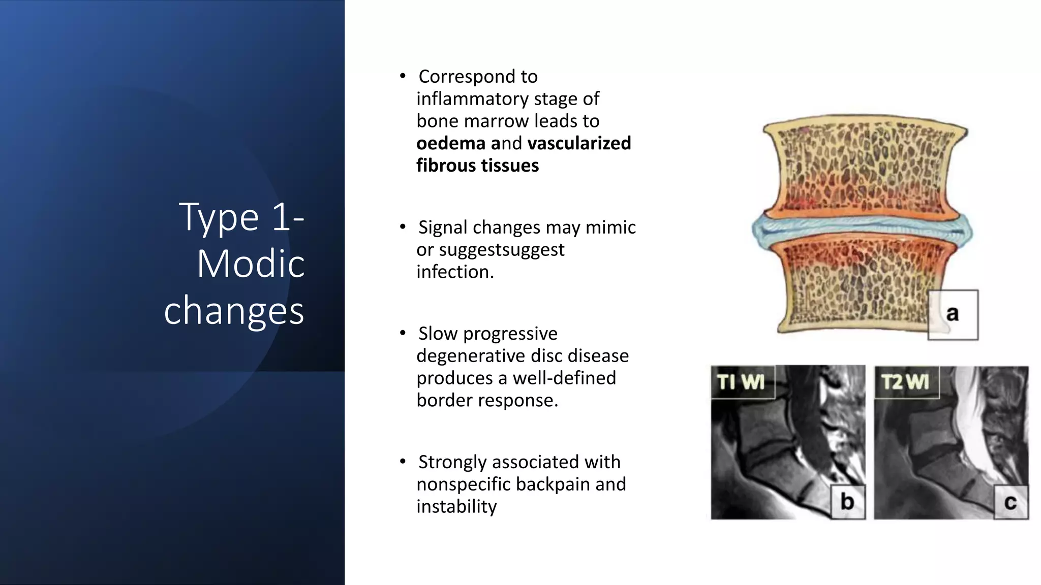Degenerative Spine Disease.pptx